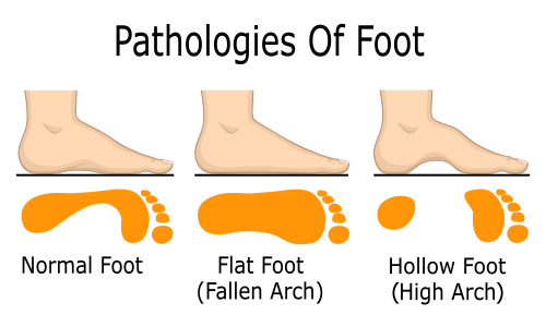 The Importance of Arch Support in Hiking Shoes - Alpenglow Adventure Sports